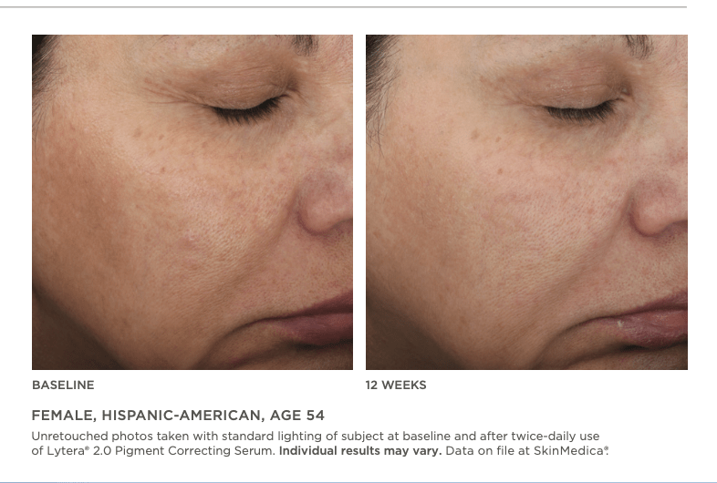 SkinMedica® Lytera® 2.0 Pigment Correcting Serum |Non-Hydroquinone Rx ...
